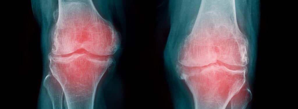Knäartros | Artroscenter